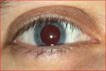 Red-Eye - Luminous Landscape
